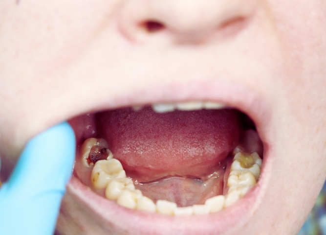 Dental Cavities: Types, Causes, and Treatment Options